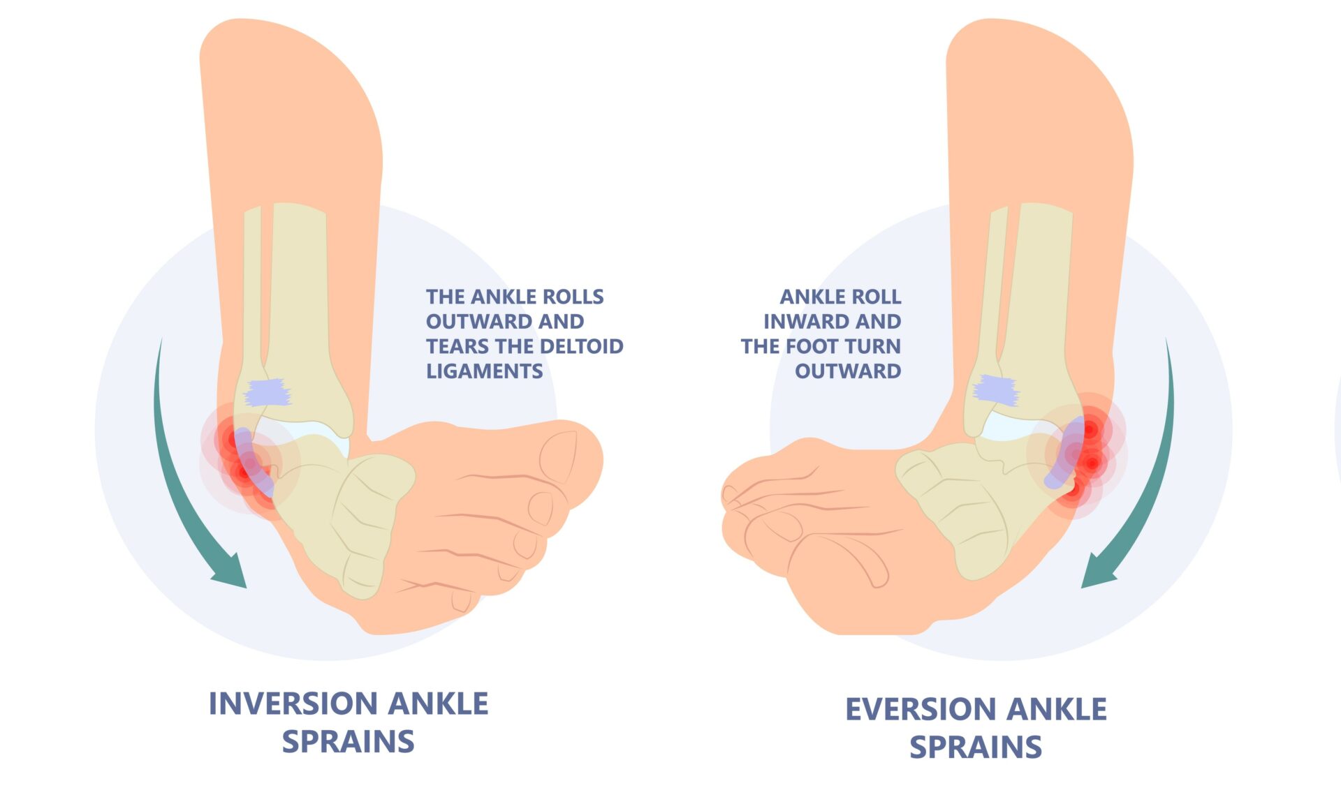 Sprunggelenksdistorsion: Symptome & Therapie | Diagnoselexikon ...